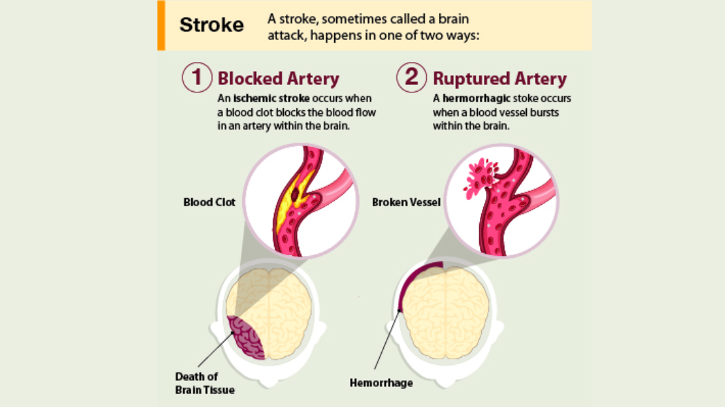 Pediatric Stroke